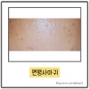 얼굴 편평사마귀 원인 및 제거 치료 방법 네이버 블로그